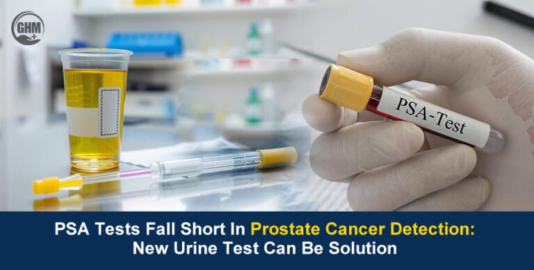 New Urine Test can be solution For Prostate Cancer Detection